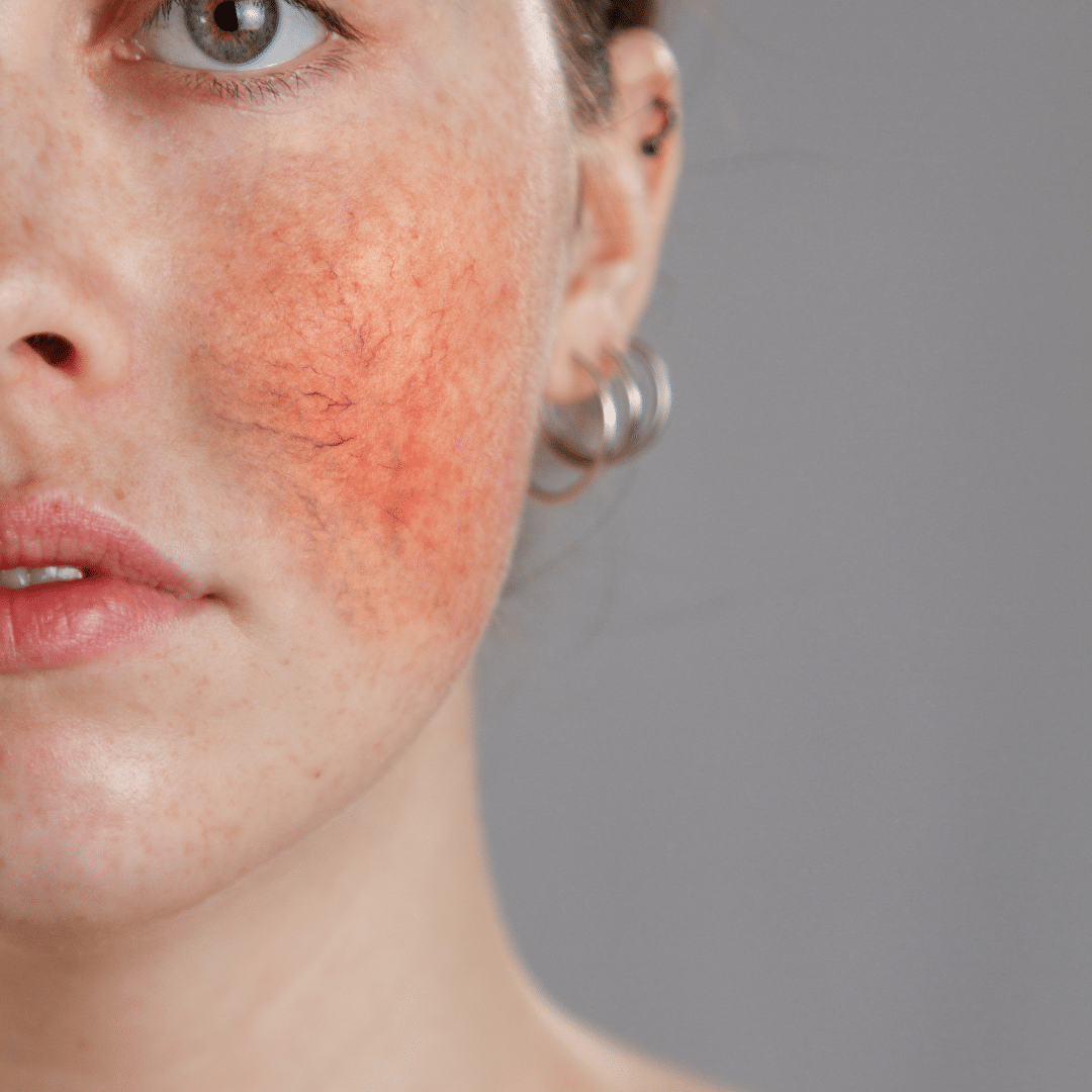 Our 5-step Protocol For Treating Rosacea - Nina Coombs